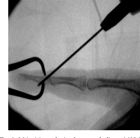 Figure 1 From Percutaneous Kirschner Wire Fixation Of Acute Mallet