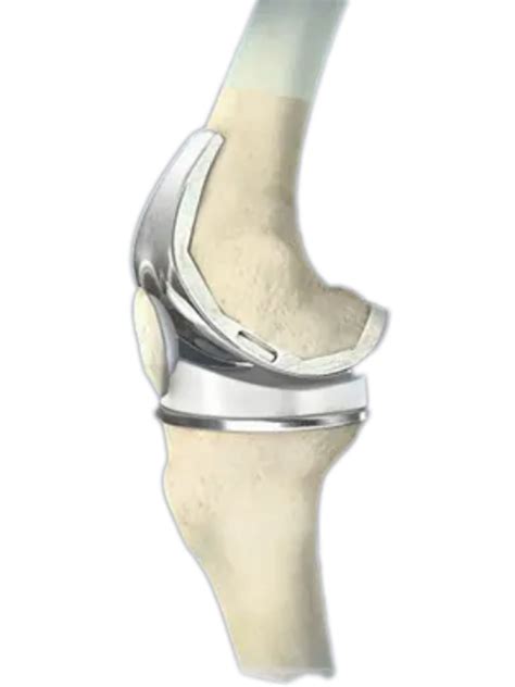 Personalized Knee Replacement With Conformis Mohawk Valley Orthopedic Associates
