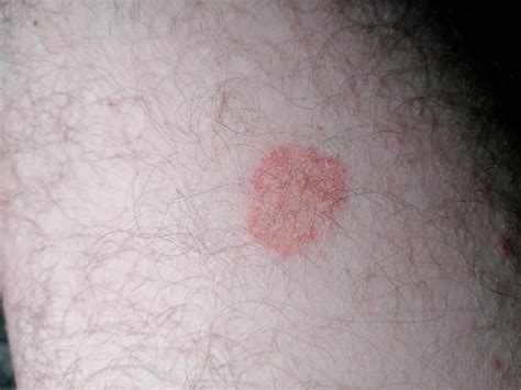 Красное пятно бляшка Вопрос дерматологу 03 Онлайн