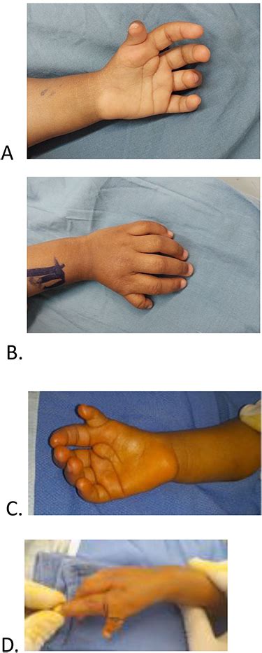 Pollicization Of Index Fingers For Bilateral Hypoplastic Thumbs Of Twi Imcrj