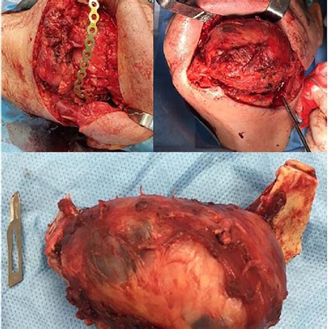 Cases Of Oral Pulse Granuloma In Edentulous Mandible N M Not Mentioned Download Scientific