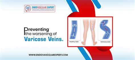 12 Varicose Veins Prevention Tips Br Dr Nikhil Bansal