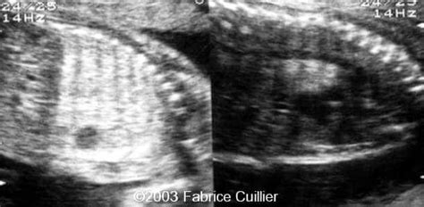 📃 Lung Sequestration Extralobar Intrathoracic