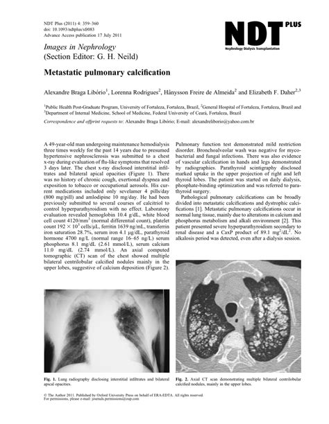 Pdf Metastatic Pulmonary Calcification