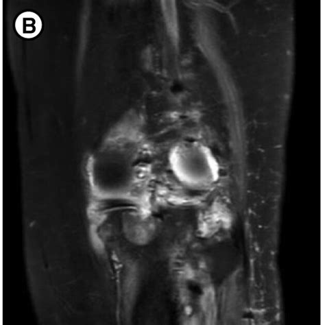 Mri Of The Left Knee Joint Multiple Abnormal Nodules In The Articular