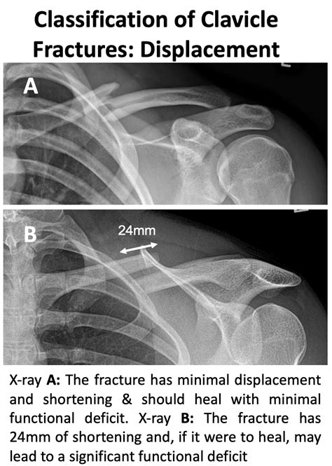 Clavicle Fracture Wikipedia Pathological Clavicle Fracture Radiology Case