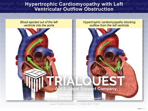 Hypertrophic Cardiomyopathy With Left Ventricular Outflow Obstruc