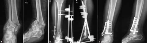 Pilon Fracture WikiProjectMed