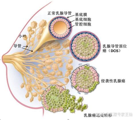 乳腺增生的五个阶段领略它的发展史 知乎
