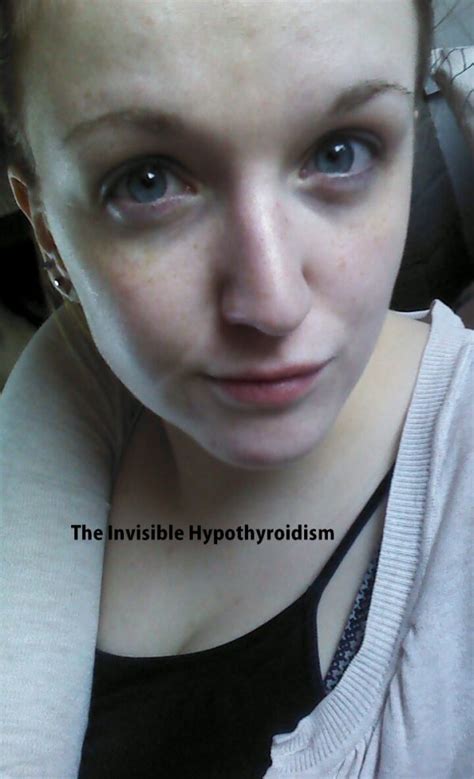 Does Borderline Hypothyroidism Need Treatment The Invisible Hypothyroidism