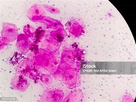 전립선 얼룩 그램 얼룩 현미경 100x 는 몇 가지 고름 세포와 상피 세포를 보여줍니다 그램 양성 디플로코치와 몇 그램 네거티브 로드모양 박테리아의 큰 수 세포에 대한 스톡