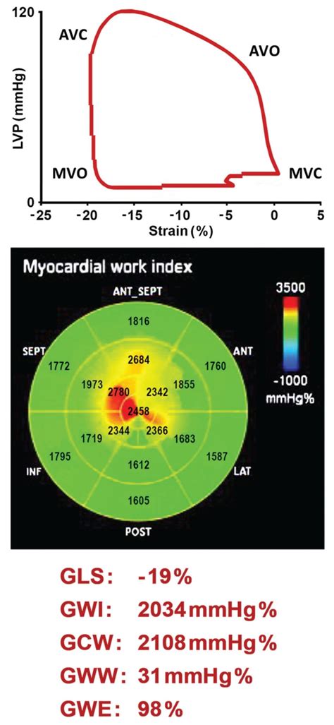 Myocardial Work Index A Novel Method For Assessment Of Myocardial