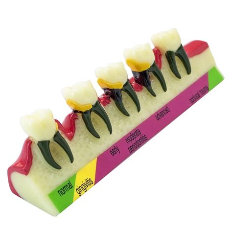 Teeth Model 4x Periodontal Disease Tooth Model Caries Model Tooth