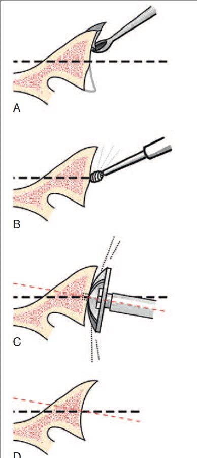Uw Shoulder And Elbow Academy The Glenoid Component In Total Shoulder Arthroplasty Getting It