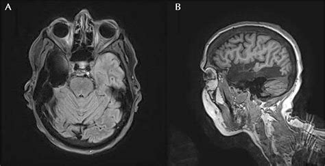 Jle Epileptic Disorders Temporal” Intermittent Rhythmic Delta Activity The True Localizing