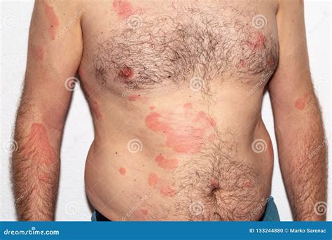 Chlorine Allergy Histamine At Ronald Wooton Blog