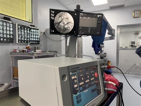 Radio Frequency Ablation Rfa For Trigeminal Neuralgia Prof Dr