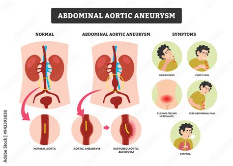 Abdominal Aortic Aneurysm With Symptoms Medical Poster Infographic