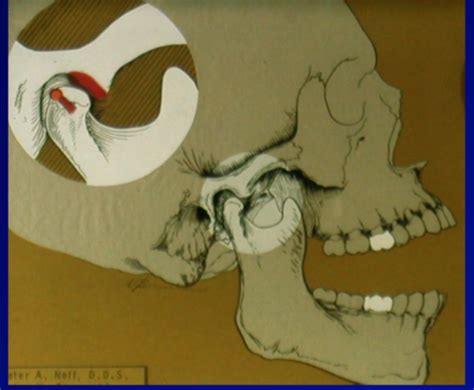 TMJ And Occlusion Flashcards Quizlet