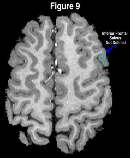 Inferior Frontal Sulcus
