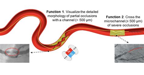 Soft Robotic Tool Provides New Eyes In Endovascular Surgery Max Planck Institute For