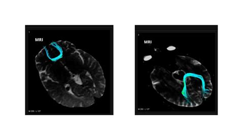 Diffusion Tensor Imaging Medicine Ddpptx