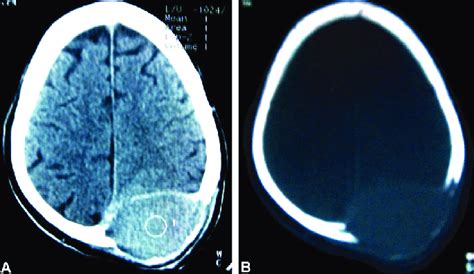 Ct Scan Head A With Bone Window B Showing An Expansile Lytic Lesion Download Scientific