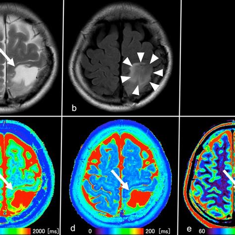 Images From A 49 Year Old Woman With Idh Mutant Diffuse Astrocytoma Download Scientific Diagram