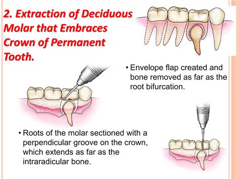 Principles And Steps Of Surgical Tooth Extraction Pptx