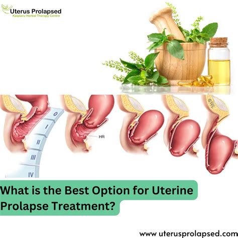 What Is The Best Option For Uterine Prolapse Treatment