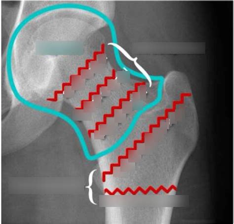 Identifying Fractures On Xray Diagram Quizlet