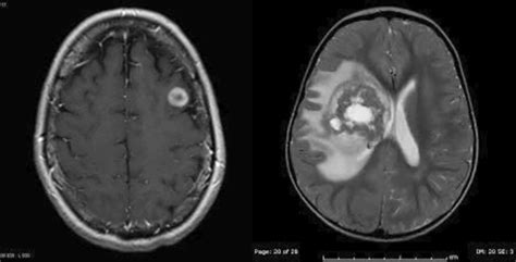 Malignant Vs Benign Brain Tumor Umc Victoria Hospital Uganda Yes
