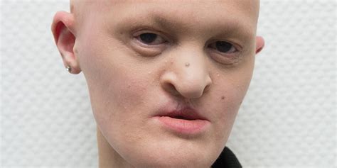 Ectodermal Dysplasia Hair