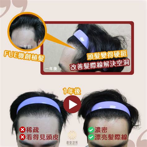 Fue植髮適合局部掉髮嗎｜手術費用、優缺點、案例與常見問題 萌髮植髮診所