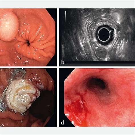 Hemorrhagic Duodenal Net Endoscopic Appearance Eus Appearance