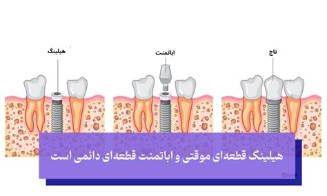 هیلینگ ایمپلنت؛ 3 نمونه از انواع هیلینگ به همراه 6 مرحله نصب آن