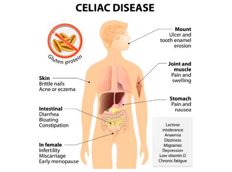 Celiac Disease Diagnostics