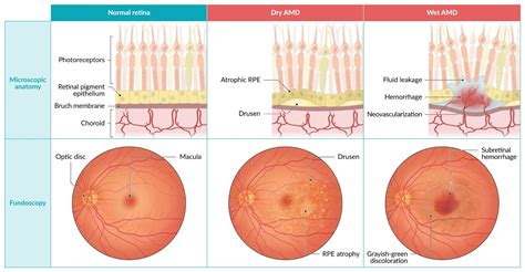 Dry Vs Wet Macular Degeneration