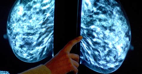 Artificial Intelligence Based Tool Developed To Estimate Cancer