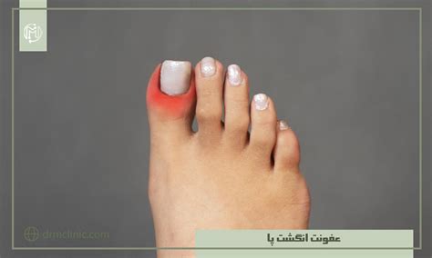 عفونت انگشت پا کلینیک ارتوپدی تخصصی فوق تخصصی