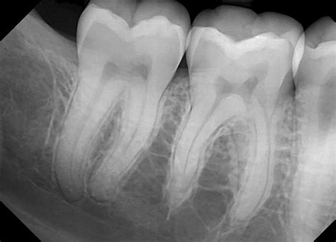 Dream Sensor Award Winning Digital X Ray Sensor Dentimax