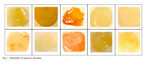 Cough And Phlegm Explained Causes Types And Concerns