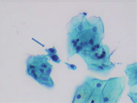 High Grade Squamous Intraepithelial Lesion Pap ×400 Surepath