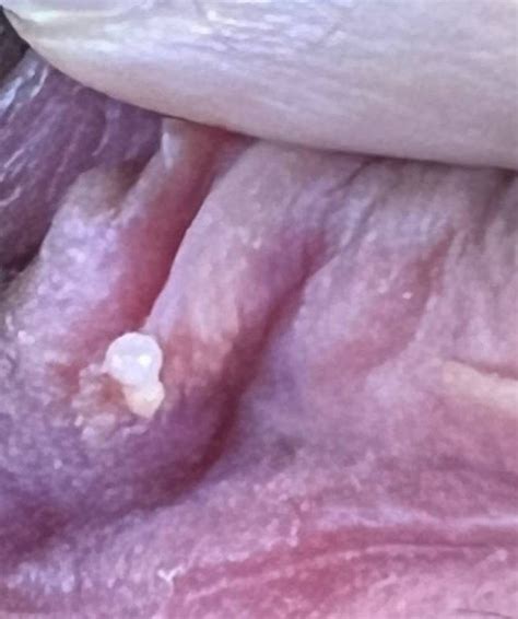 هر گردی گردو نیست، هر زگیلی هم زگیل تناسلی نیست