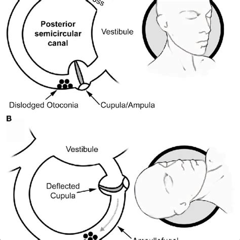 Nystagmus Characteristic Of Pc Bppv A A Right Pc Bppv Will Download Scientific Diagram