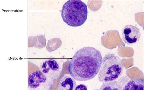 Pronormoblast Nucleus Is Large Deep Purple And Centrally Located Nuclear Chromatin Is