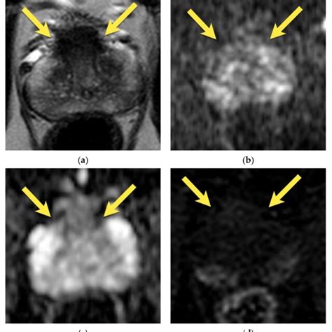 Periprostatic Venous Plexus In The Left Postero Lateral Side Of The