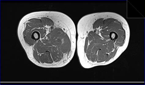 Infectious Myositis Mri Radiology Article On Infectious Myositis
