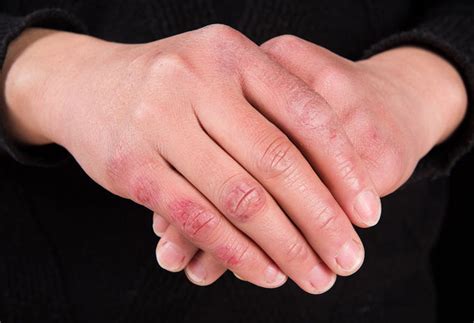 Engelures Aux Mains Comment Les éviter
