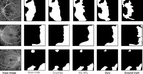 Comparison Of Dr Lesion Segmentation Results Between Our Proposed Model Download Scientific